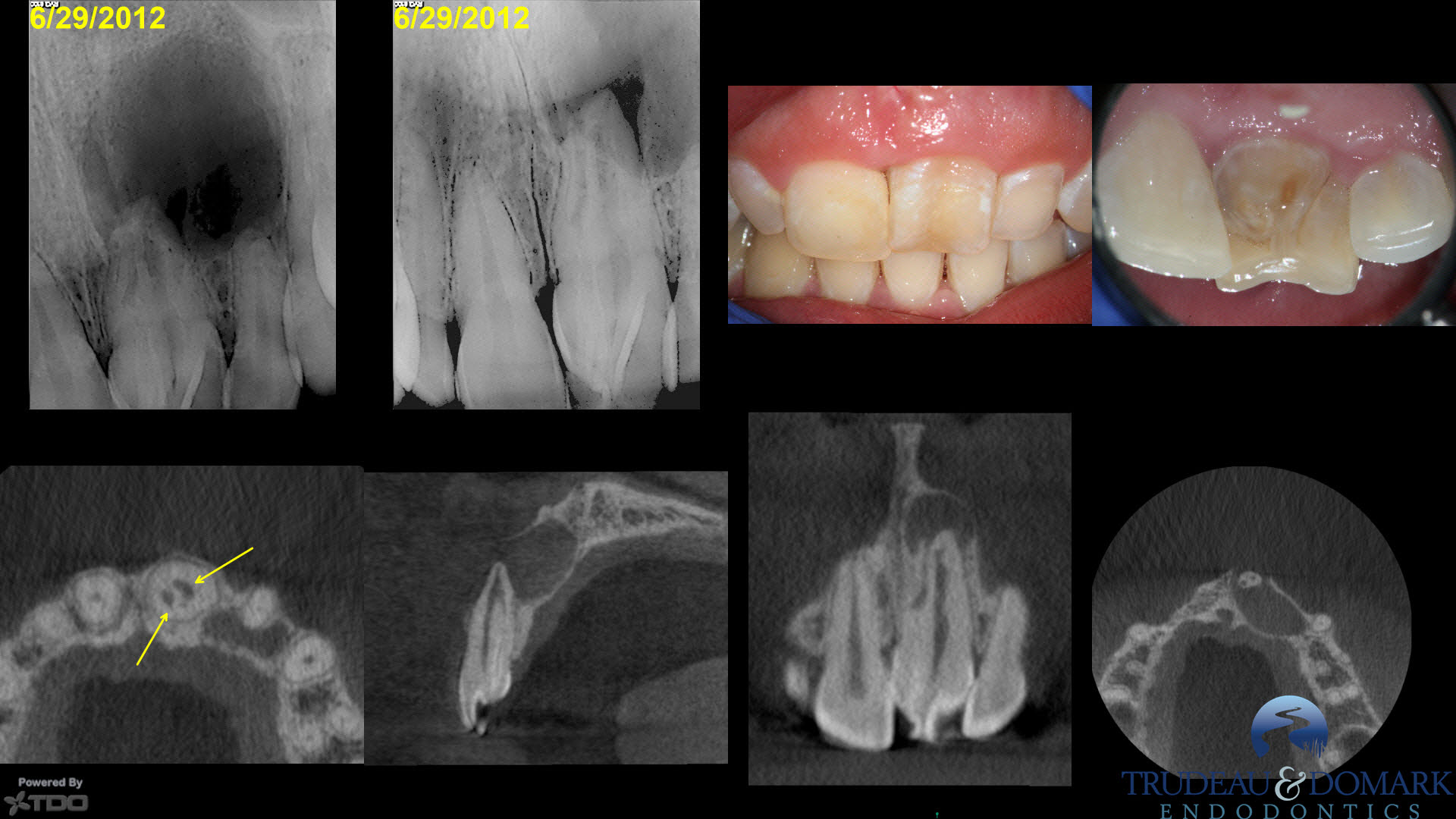 Decompression of a Dens in Dente Central Incisor – The Endo Fix